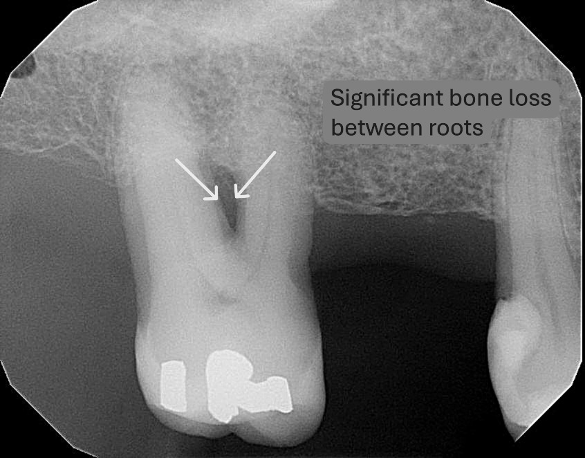 Understanding Gum Disease: Causes, Symptoms, and Treatments | Swinomish ...